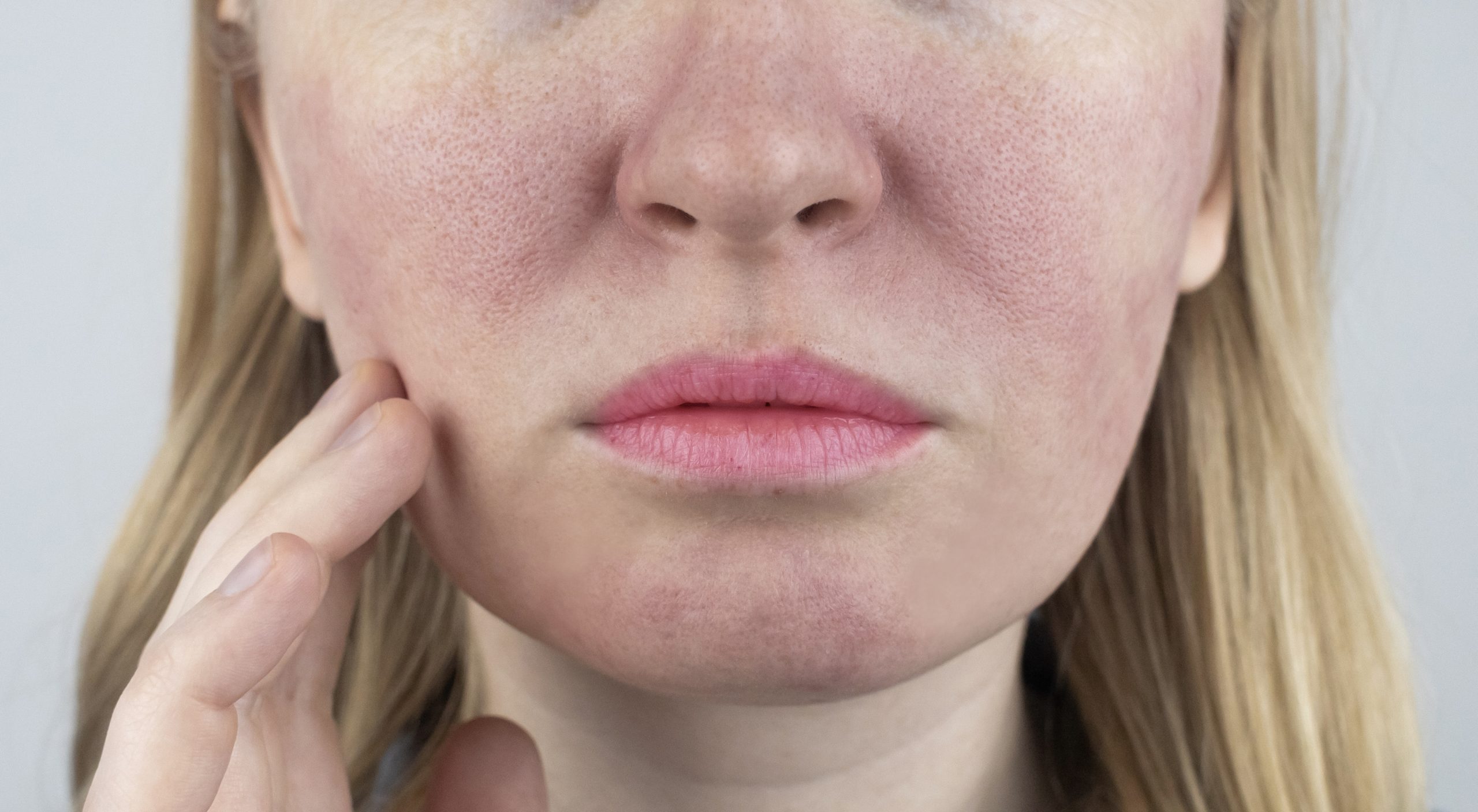 What is Rosacea? | Cosmedica